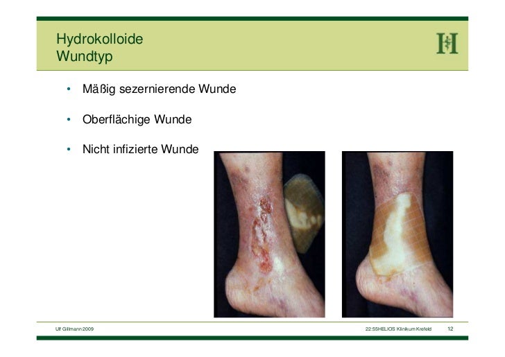 „Moderne“ Möglichkeiten der Wundtherapie