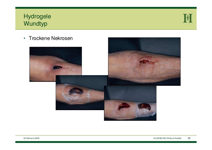 „Moderne“ Möglichkeiten der Wundtherapie