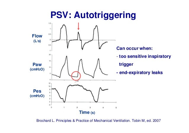 Modes of Mechanical Ventilation: The Essentials