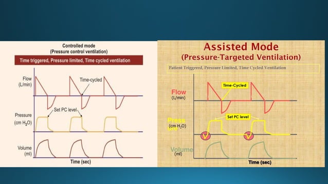 modes of ventilation(Anesthesia) - .pptx