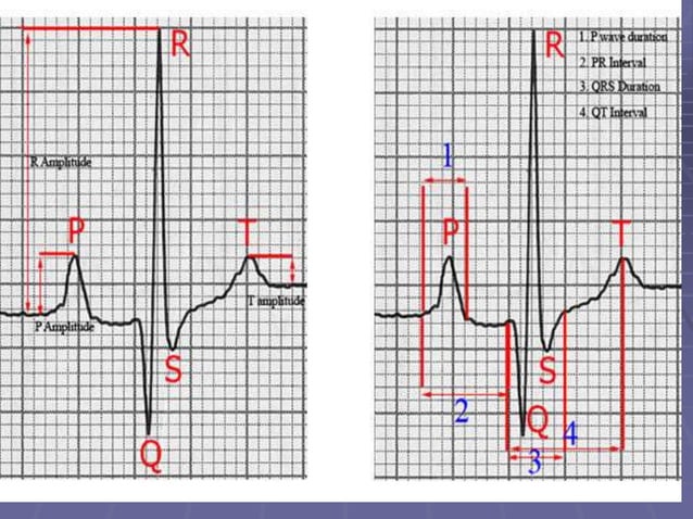 mod_i-12_lead_ekgs.ppt | Heart and Cardiovascular Diseases | Diseases ...