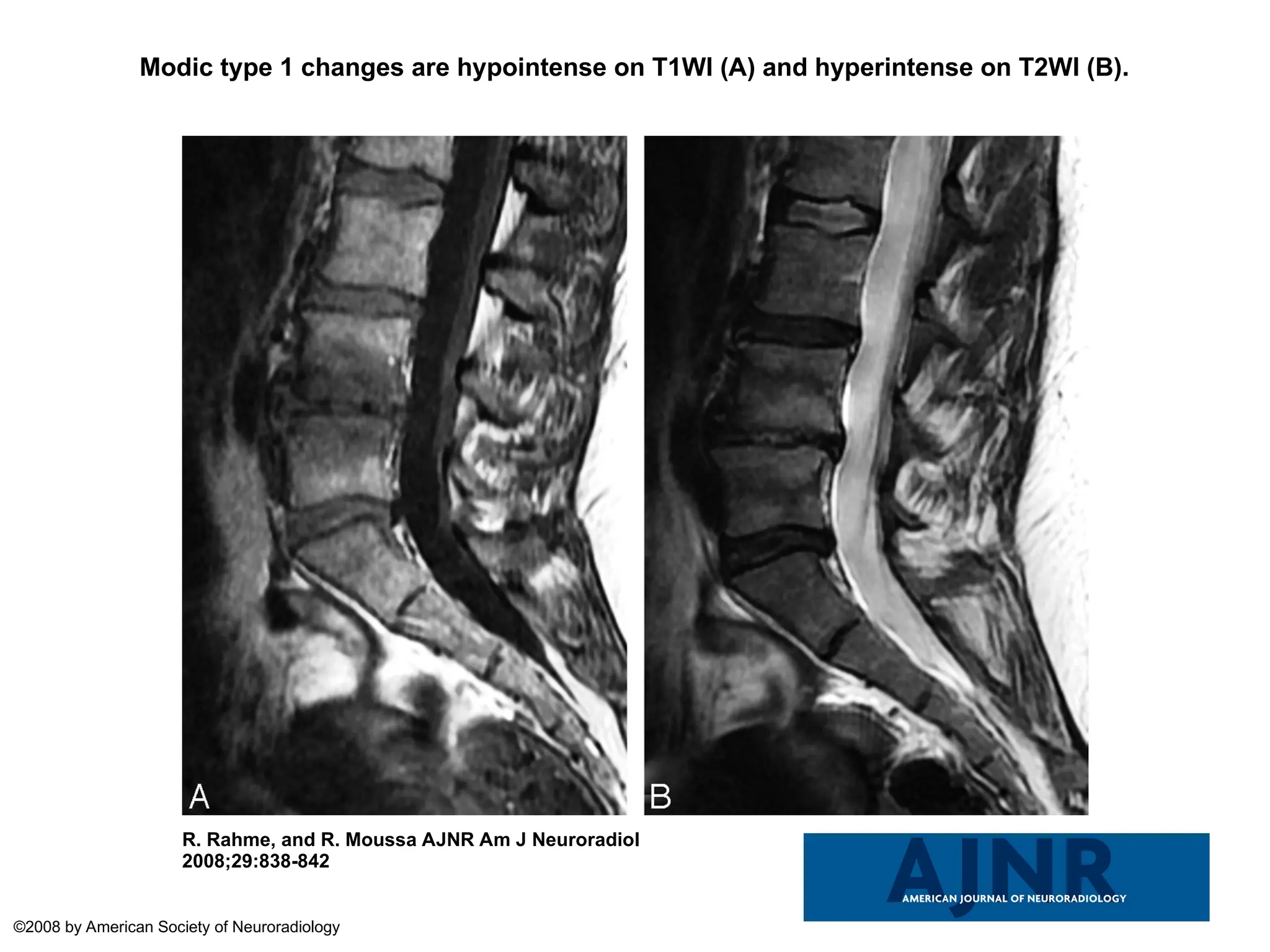 Modic changes on degenerative disc spine.ppt