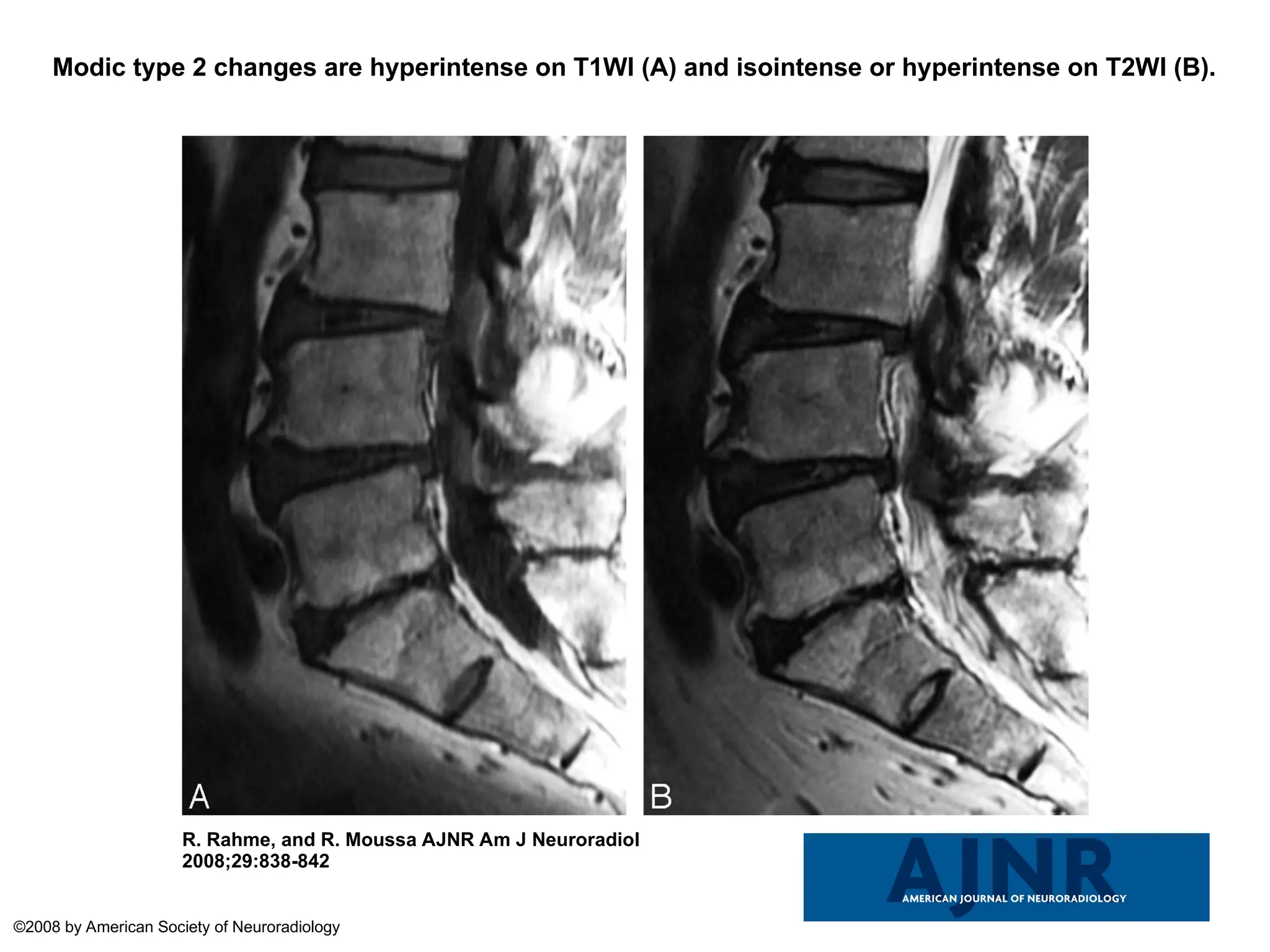 Modic changes on degenerative disc spine.ppt