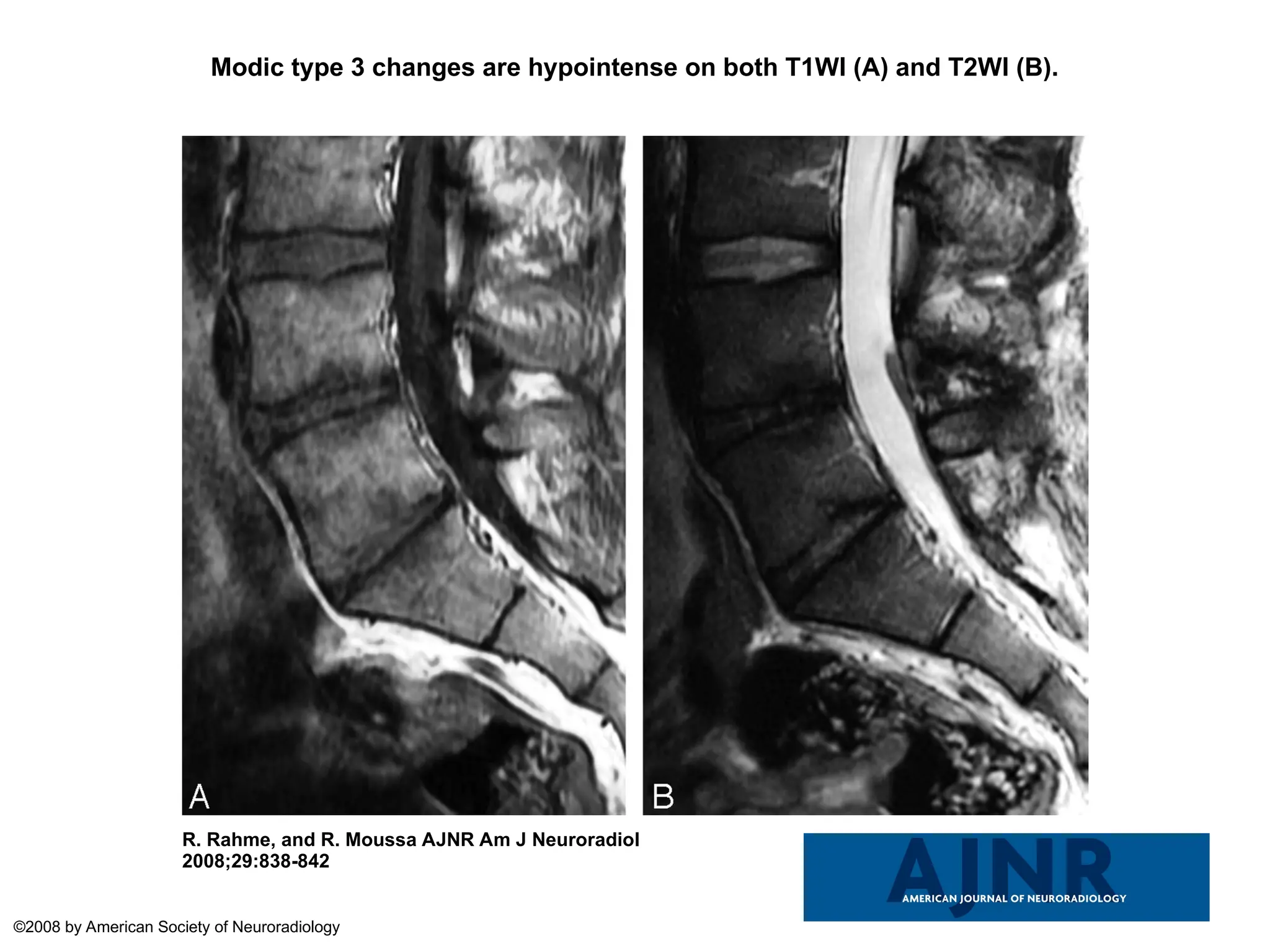 Modic changes on degenerative disc spine.ppt