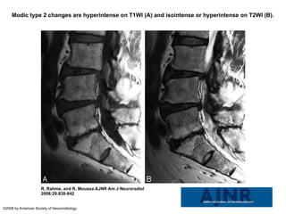 Modic changes on degenerative disc spine.ppt