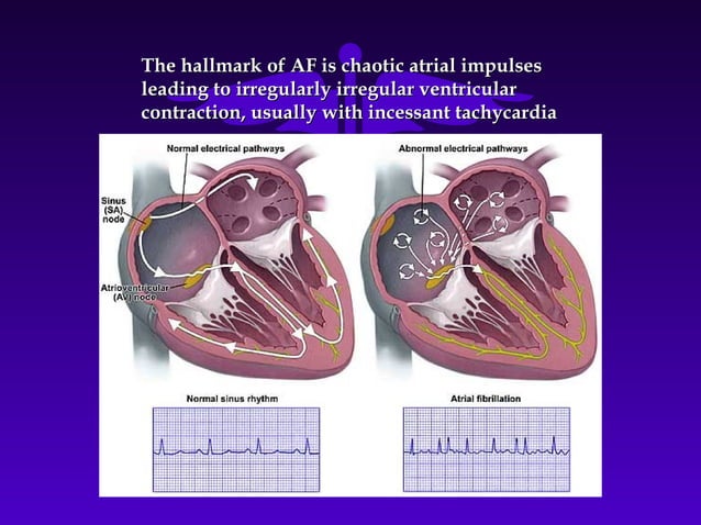 atrial fibrillation talk 2009 | PPT | Heart and Cardiovascular Diseases ...