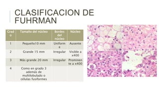 Modificaciones a la clasificacion de gleason y fuhrman | PPT