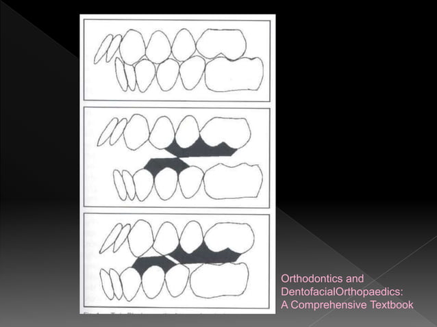 Modification of twin block functional appliance | PPT