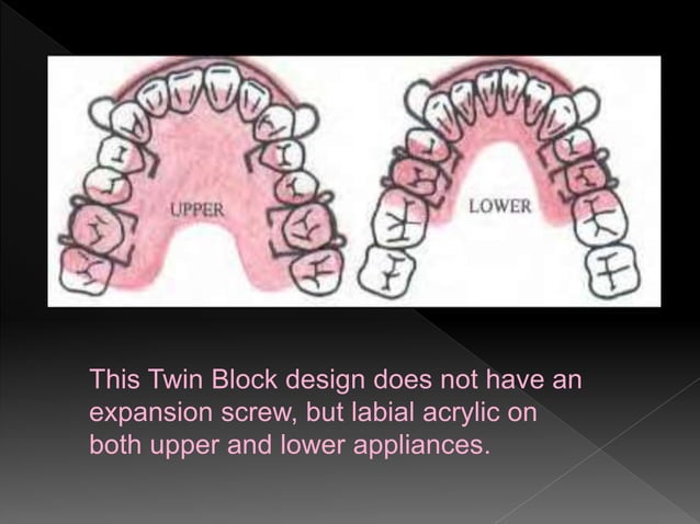 Modification of twin block functional appliance | PPT