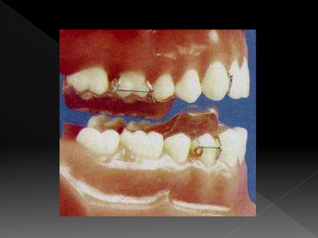 Modification of twin block functional appliance | PPT