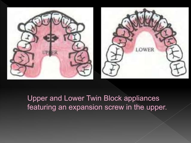 Modification of twin block functional appliance | PPT