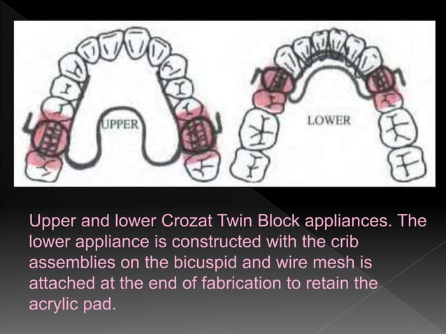 Modification of twin block functional appliance | PPT