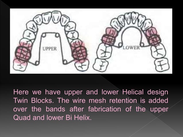 Modification of twin block functional appliance | PPT
