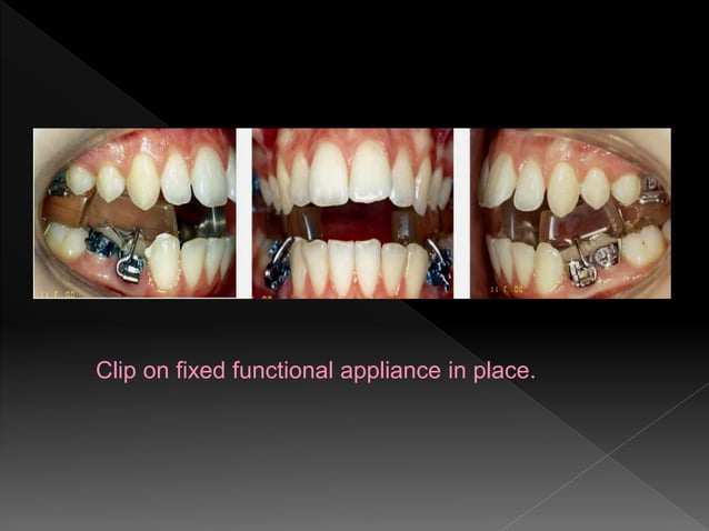 Modification of twin block functional appliance | PPT