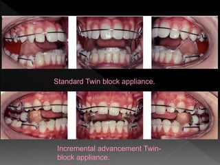Modification of twin block functional appliance | PPT