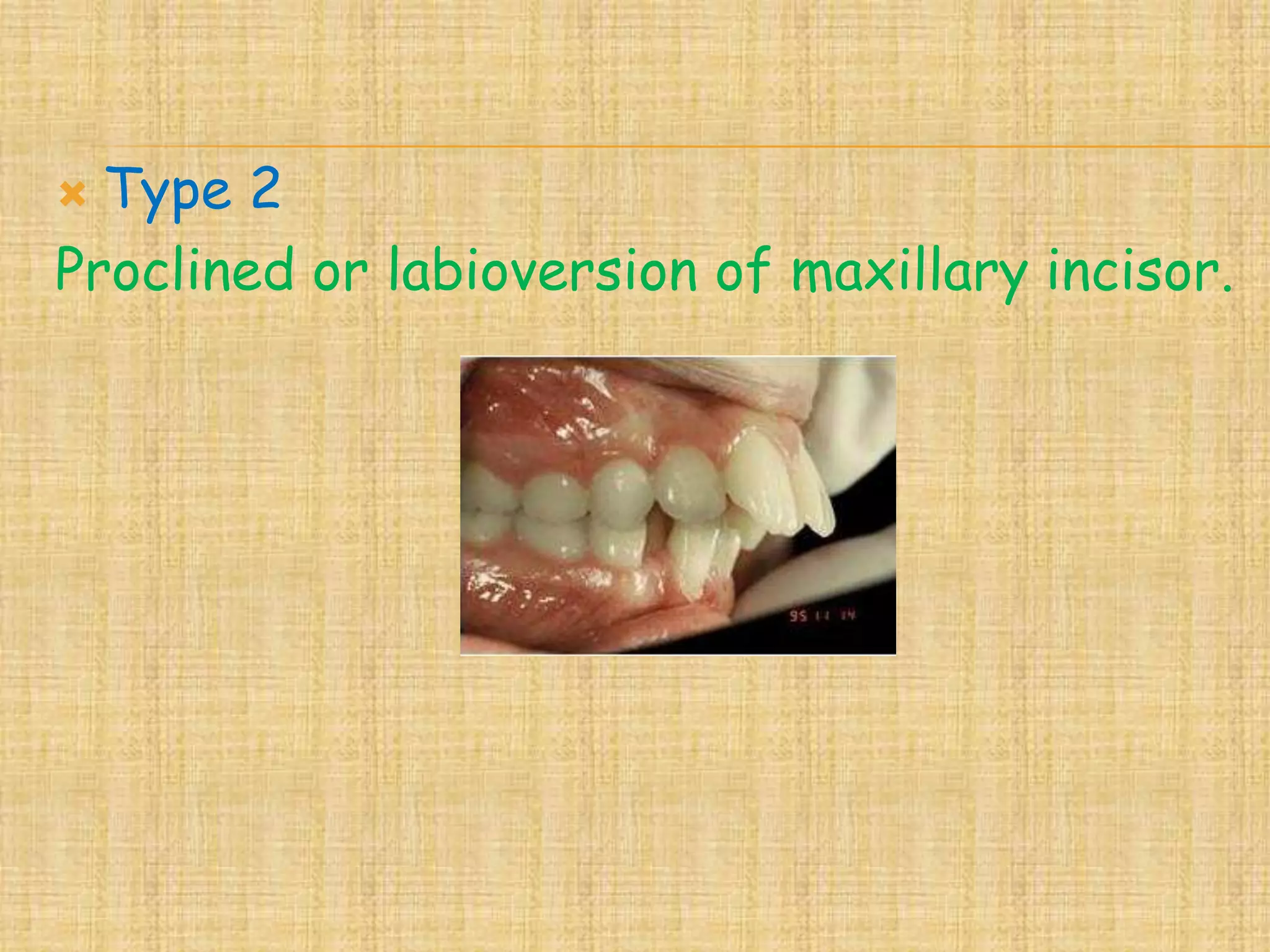 Modifications of angle`s classification | PPTX