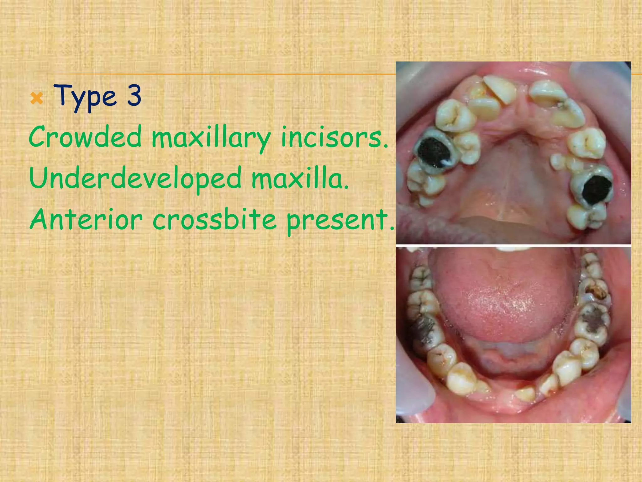 Modifications of angle`s classification | PPTX