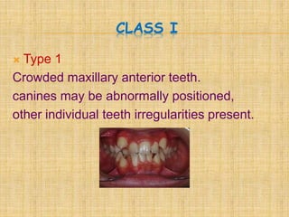 Modifications of angle`s classification | PPTX