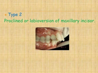 Modifications of angle`s classification | PPTX