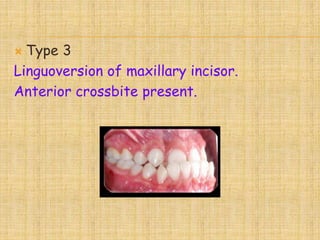 Modifications of angle`s classification | PPTX