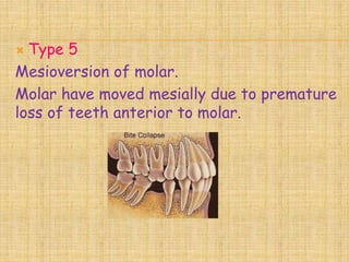 Modifications of angle`s classification | PPTX