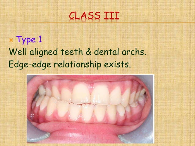 Modifications of angle`s classification | PPTX