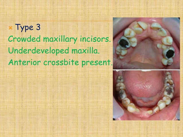 Modifications of angle`s classification | PPTX