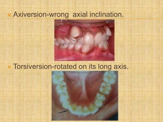 Modifications of angle`s classification | PPTX