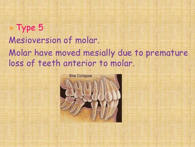 Modifications of angle`s classification