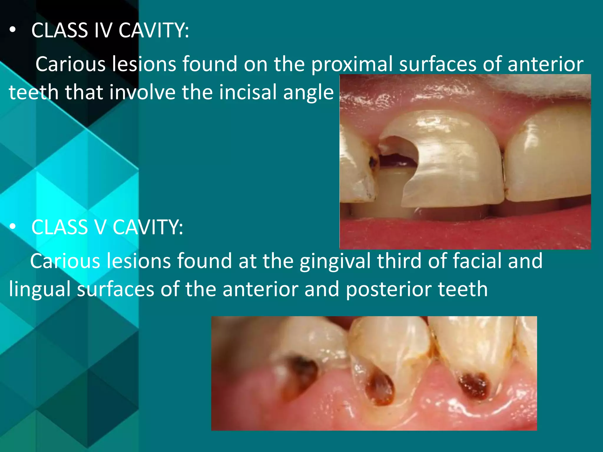 Modifications of cavity preparations in pediatric dentistry | PPTX