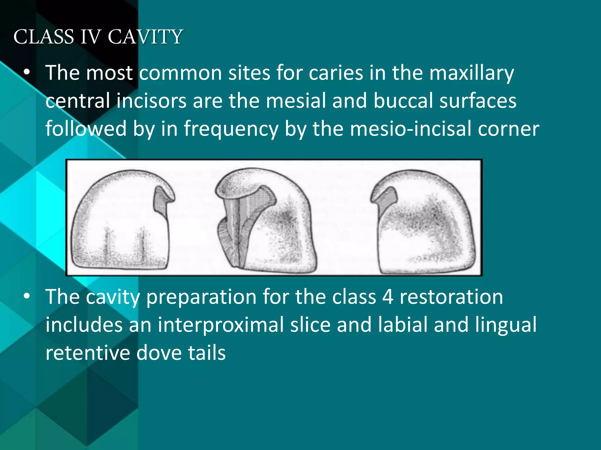 Modifications of cavity preparations in pediatric dentistry | PPTX