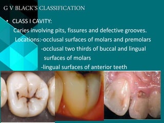 Modifications of cavity preparations in pediatric dentistry | PPTX