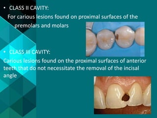 Modifications of cavity preparations in pediatric dentistry | PPTX