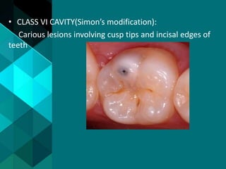 Modifications of cavity preparations in pediatric dentistry | PPTX