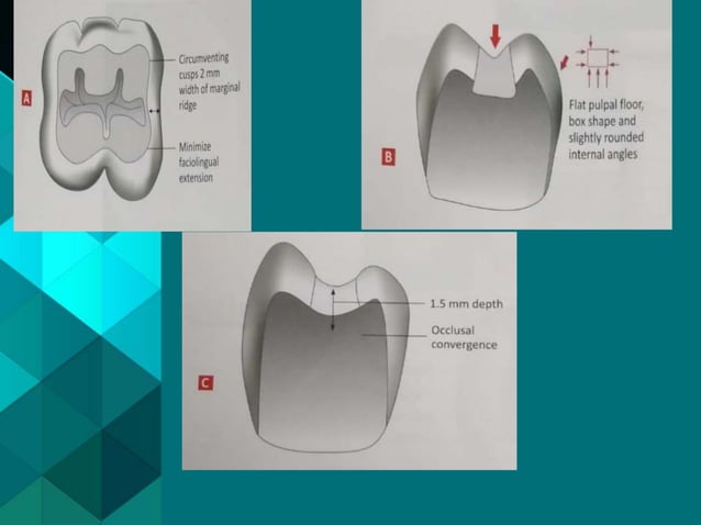 Modifications of cavity preparations in pediatric dentistry | PPTX