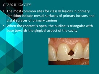 Modifications of cavity preparations in pediatric dentistry | PPTX