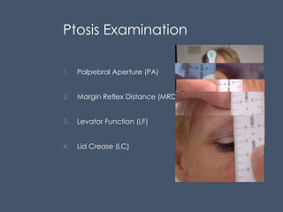 Adult & Paediatric Ptosis | PPTX