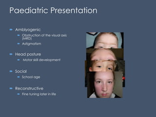 Adult & Paediatric Ptosis | PPTX