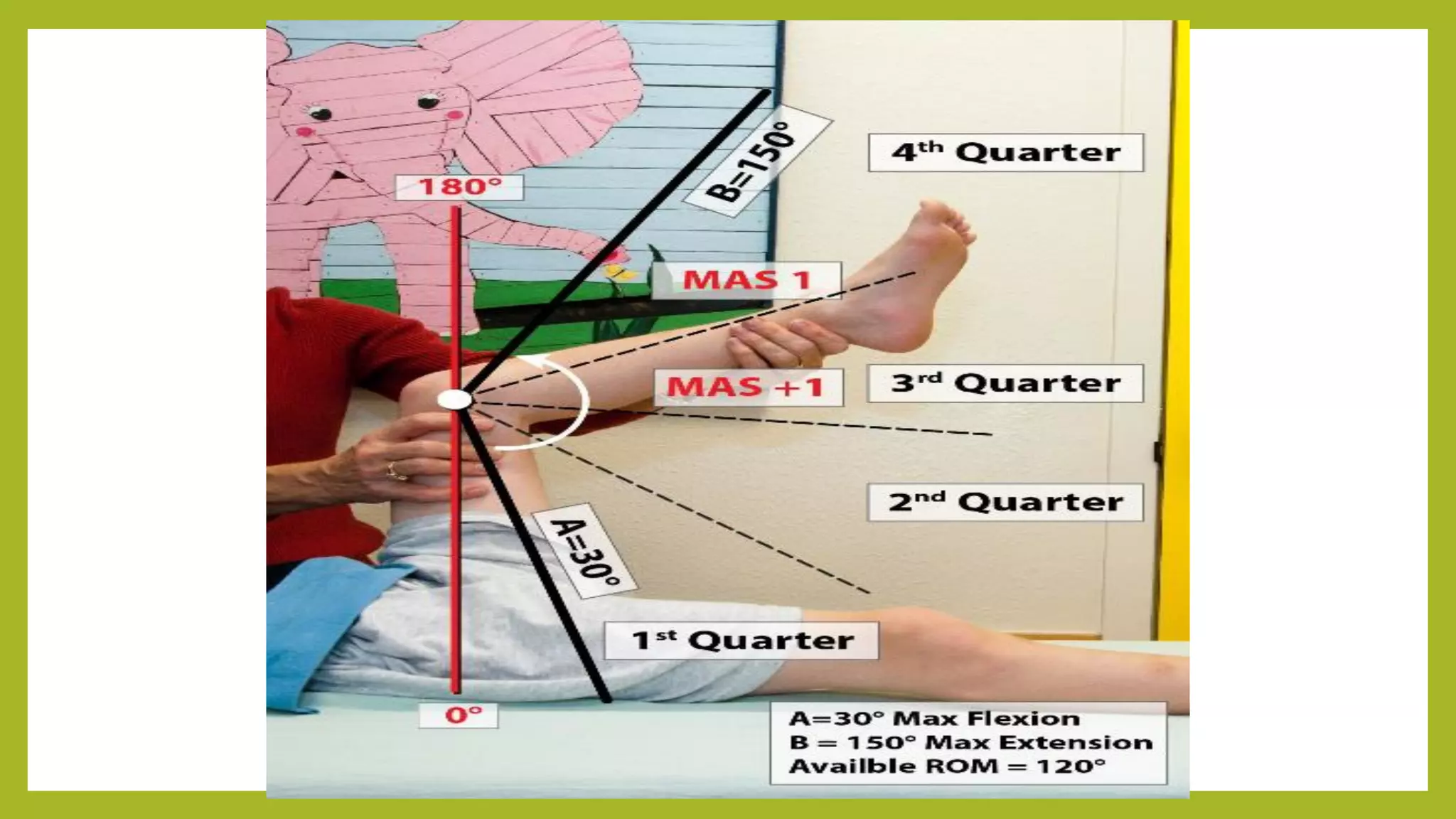 Modified ashworth scale application | PDF