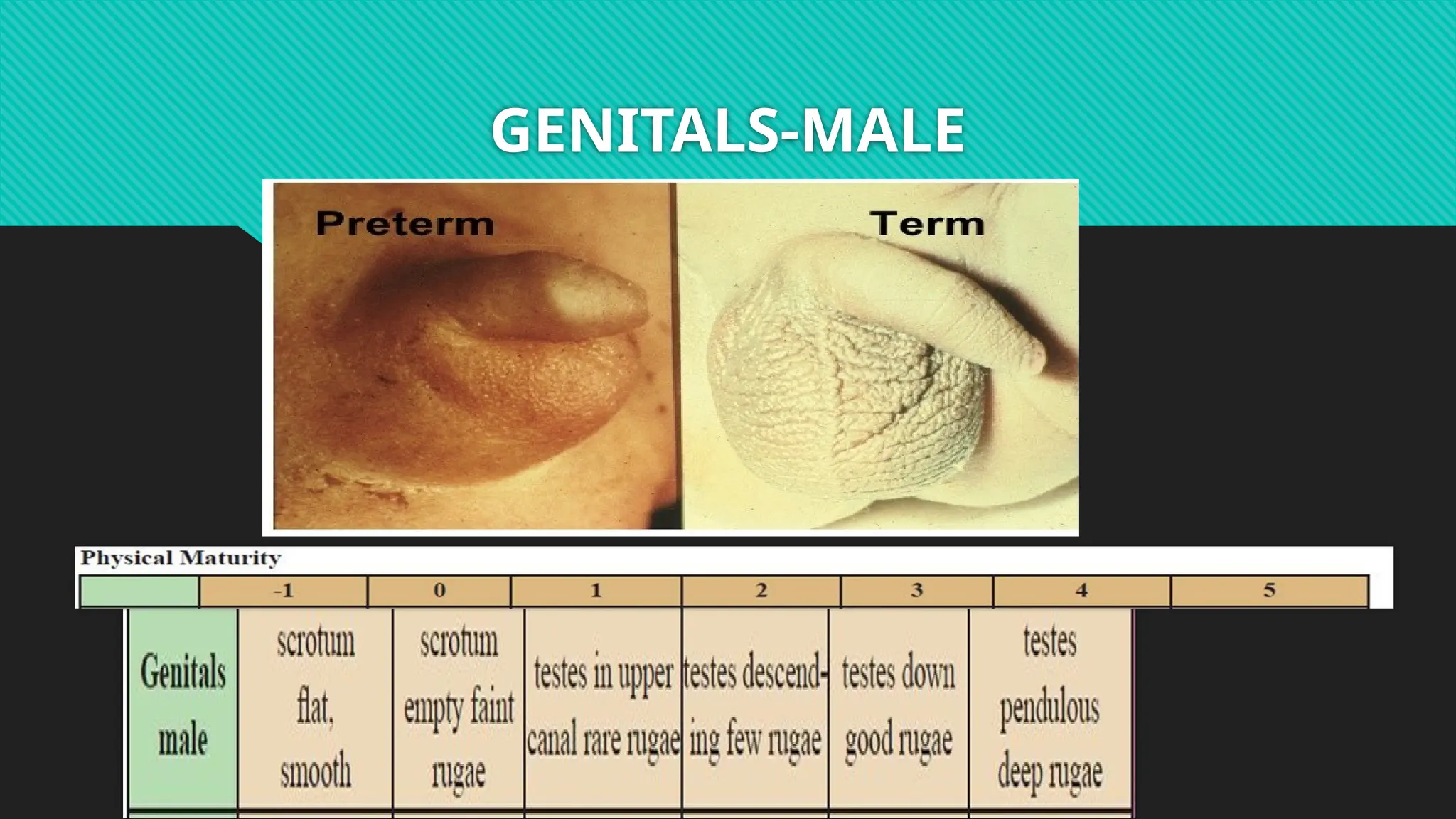 Modified Ballard score and newborn maturity | PPT