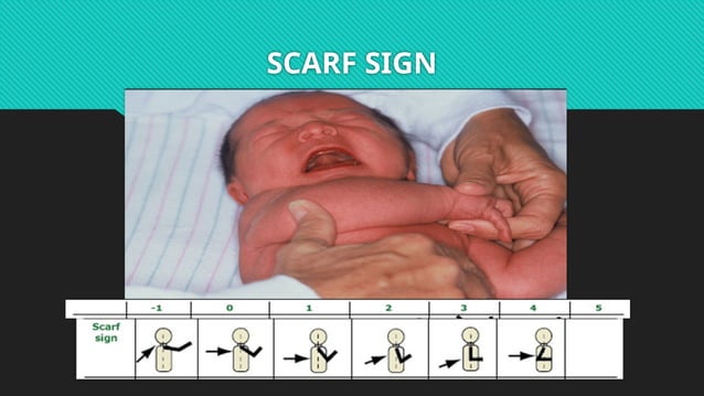 Modified Ballard score and newborn maturity | PPT