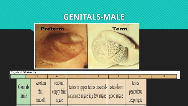 Modified Ballard score and newborn maturity | PPT