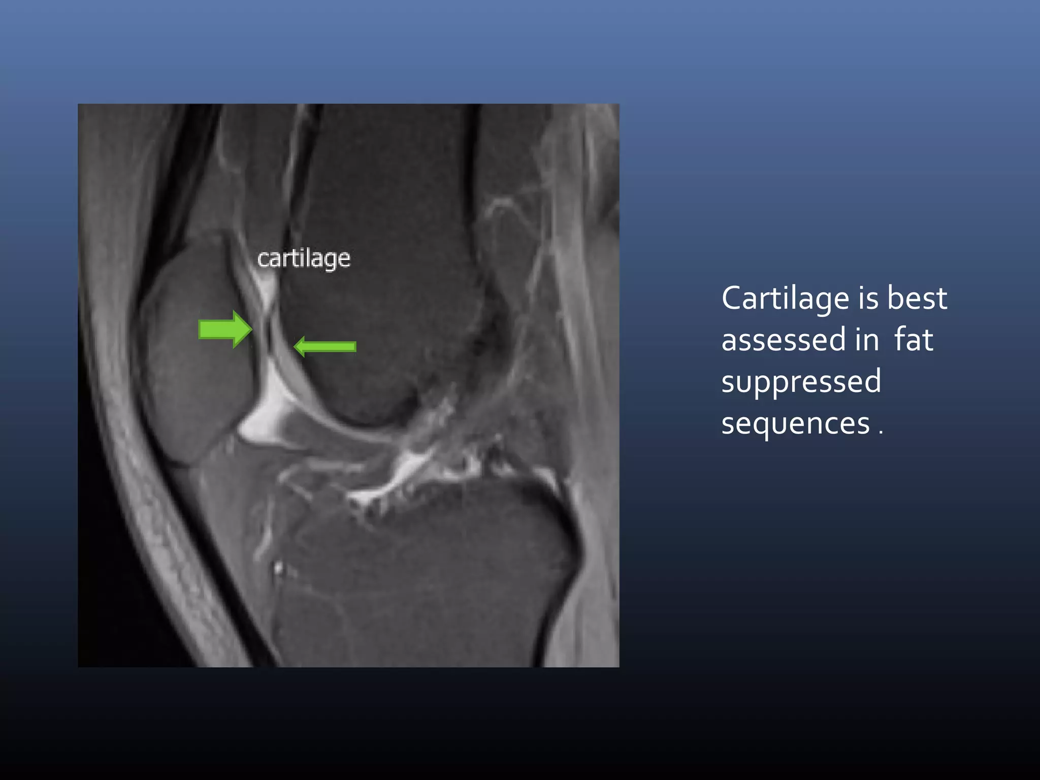 Cartilage imaging simplified | PPT