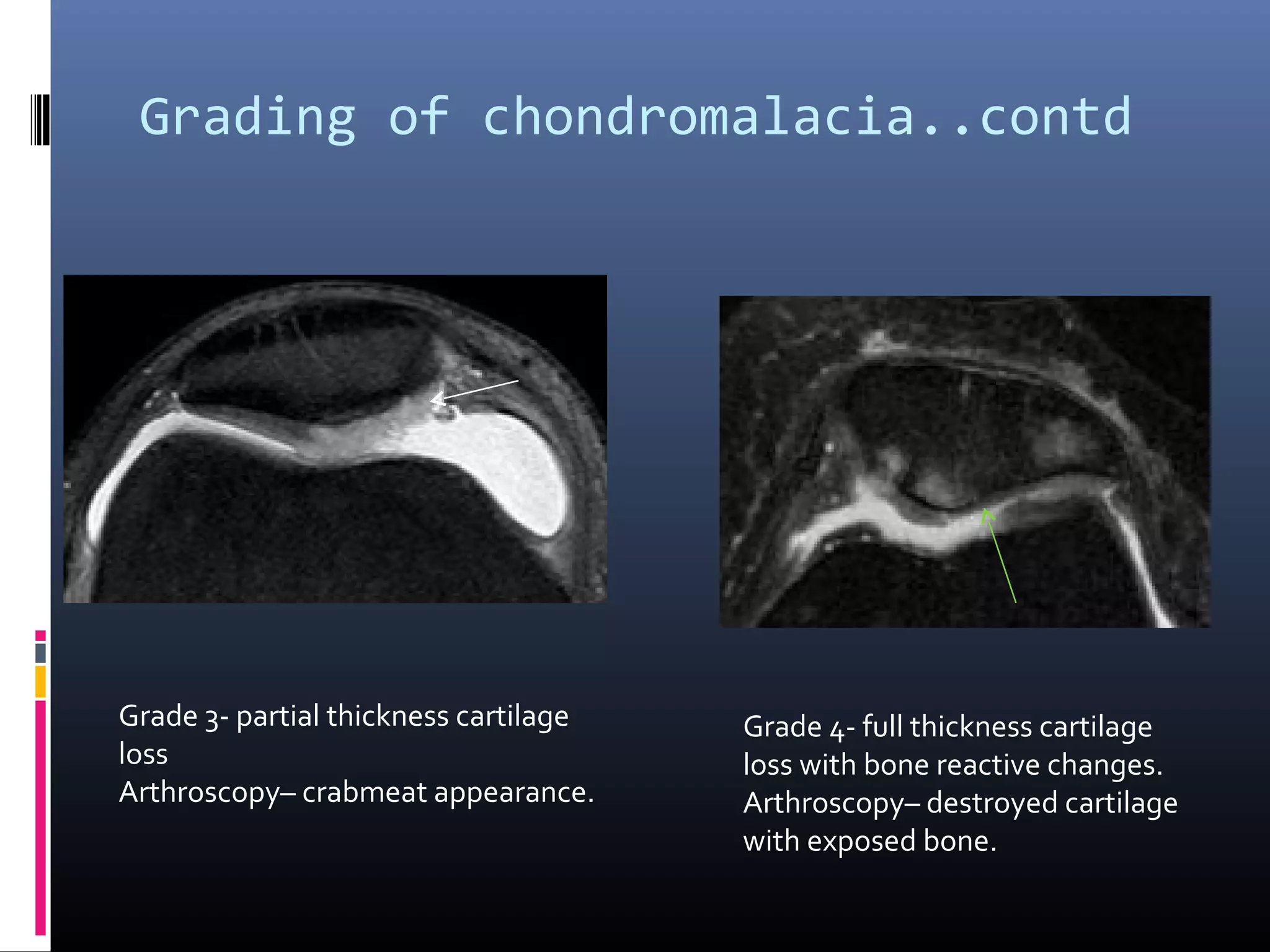 Cartilage imaging simplified | PPT