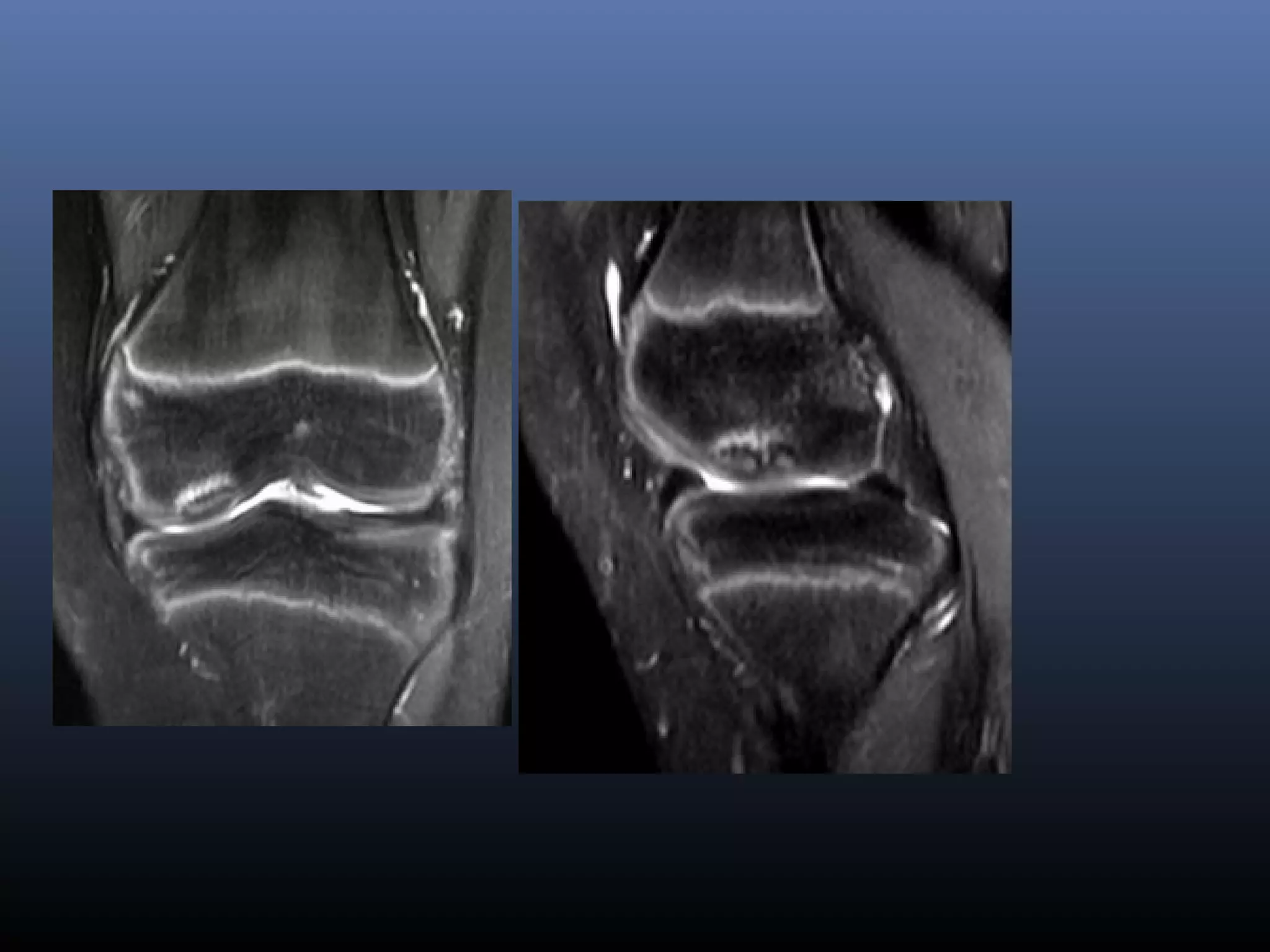 Cartilage imaging simplified | PPT