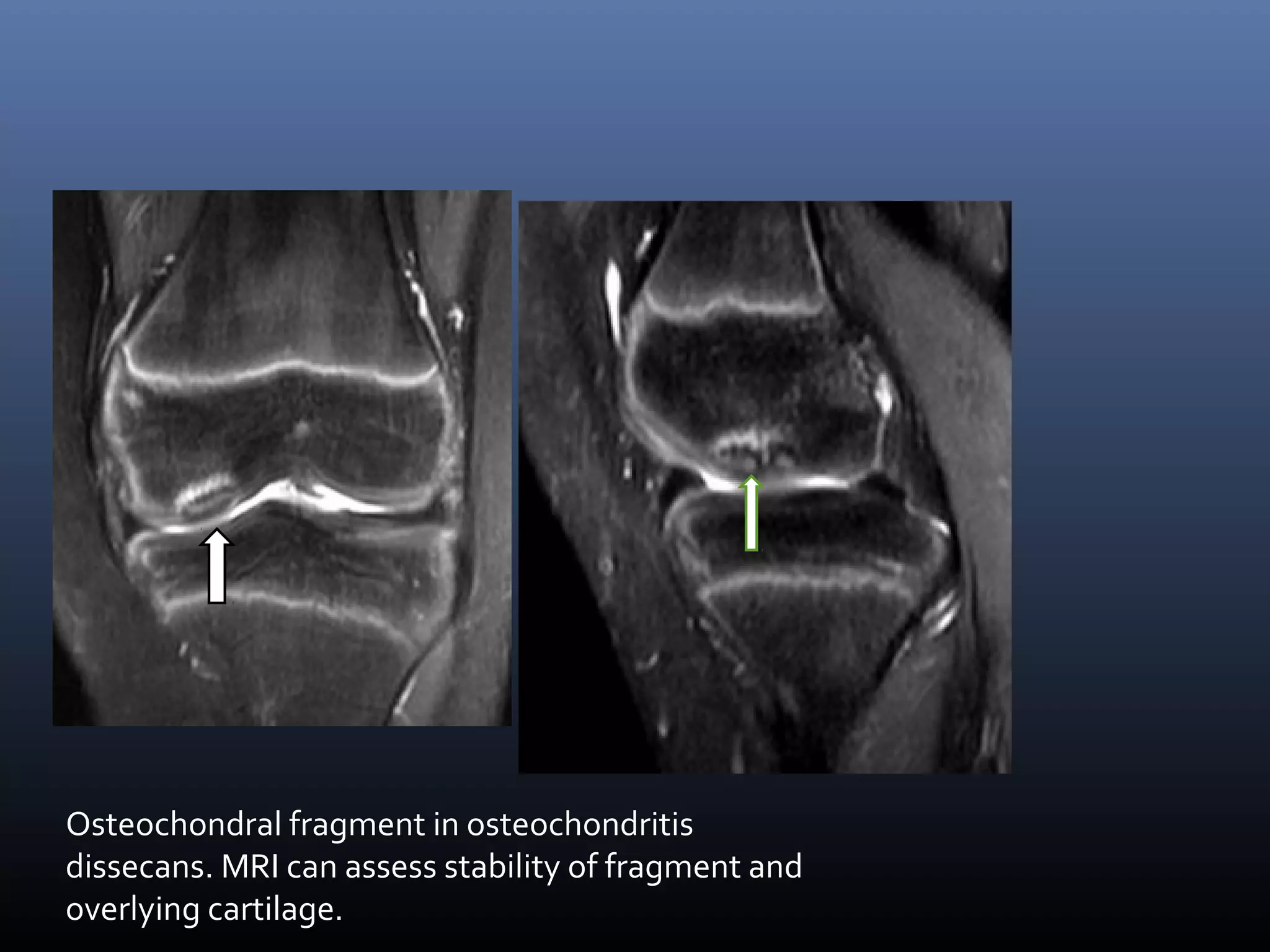 Cartilage imaging simplified | PPT