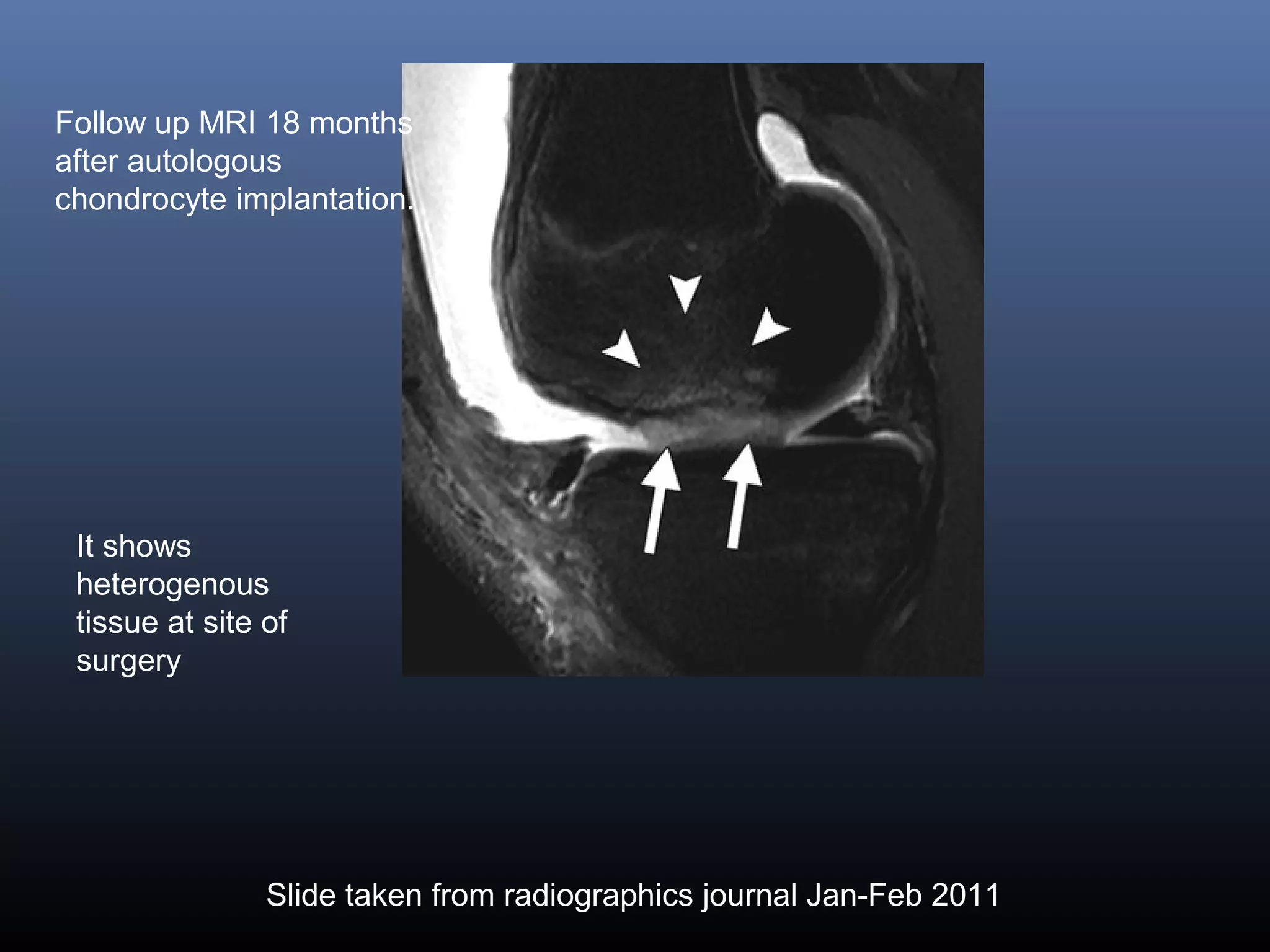 Cartilage imaging simplified | PPT