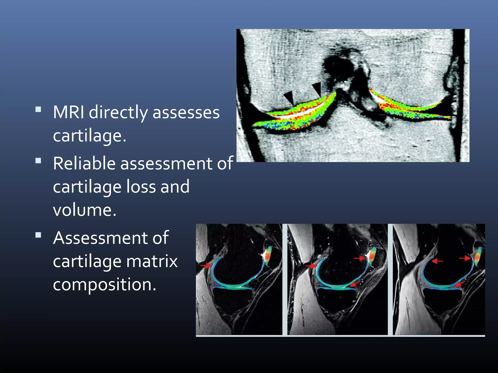 Cartilage imaging simplified | PPT