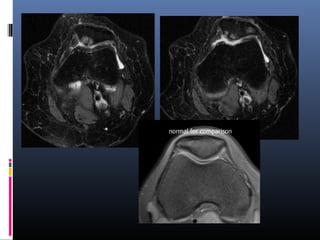 Cartilage imaging simplified | PPT