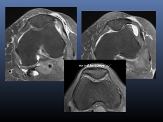 Cartilage imaging simplified | PPT